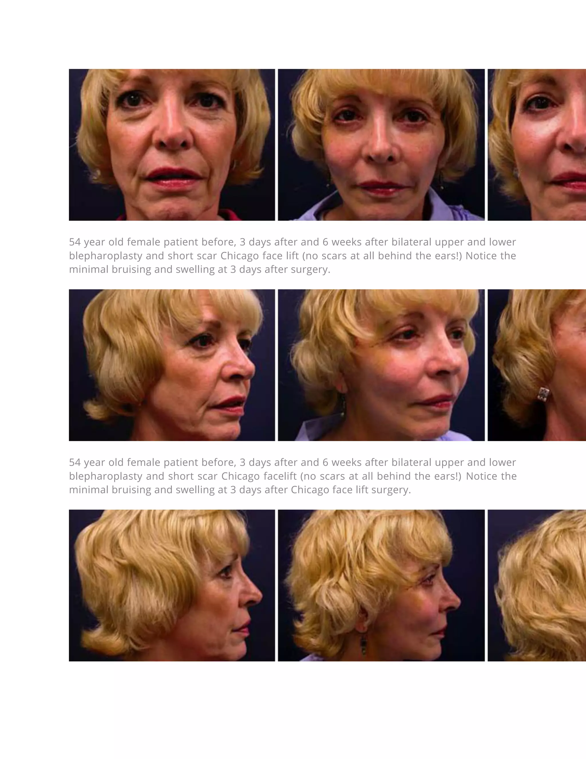 Minimal Incision Facelift Surgery and Lower Face Lift Incisions | PDF