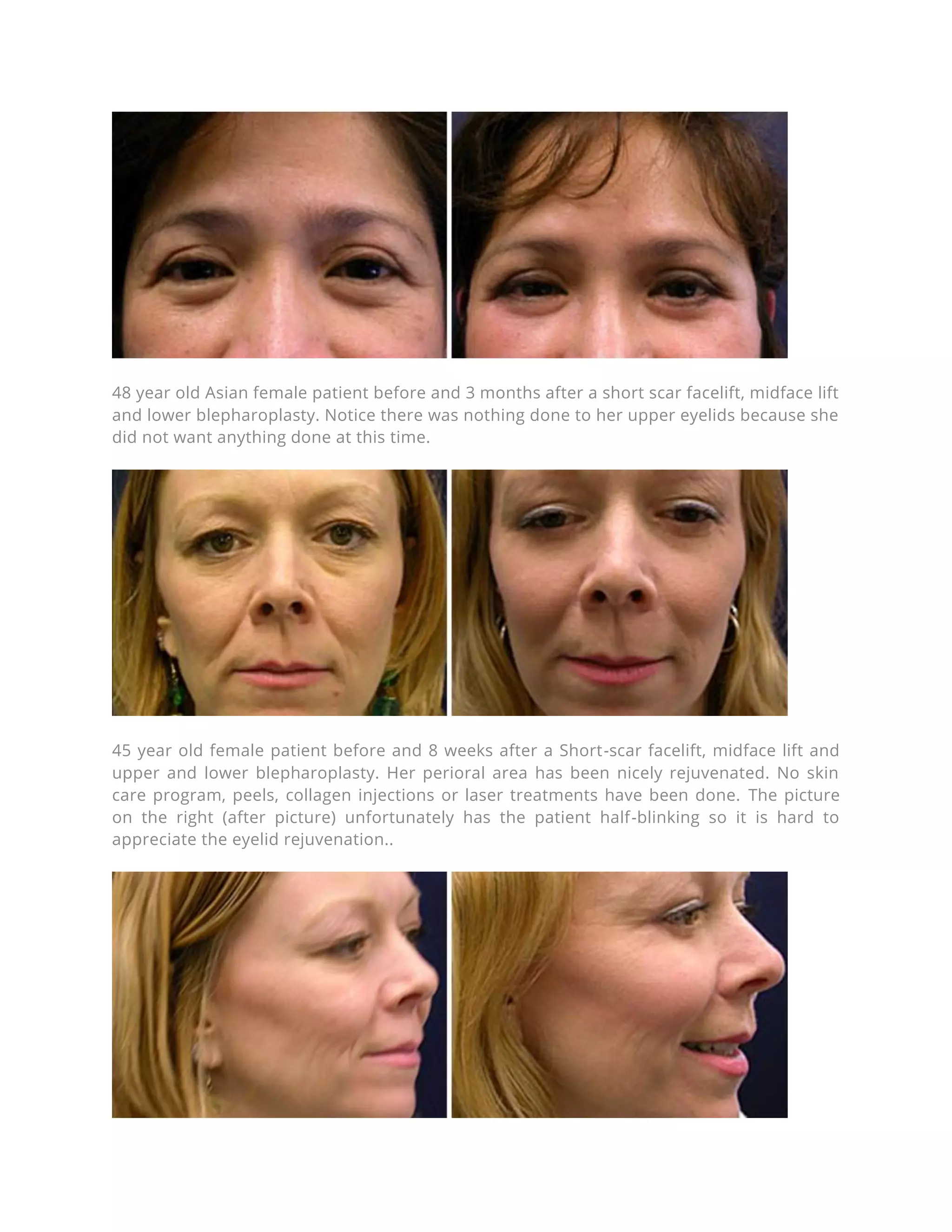 Minimal Incision Facelift Surgery and Lower Face Lift Incisions | PDF