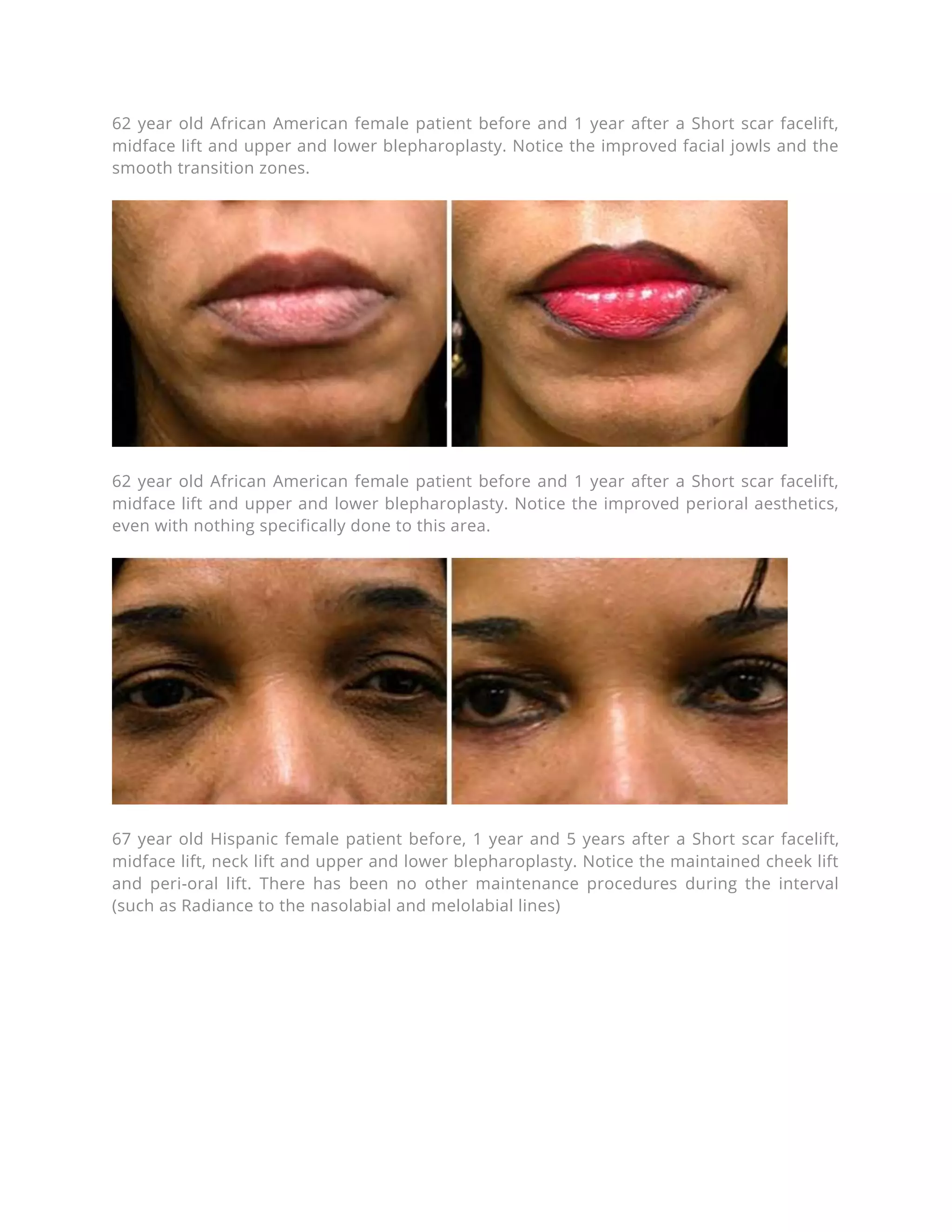Minimal Incision Facelift Surgery and Lower Face Lift Incisions | PDF