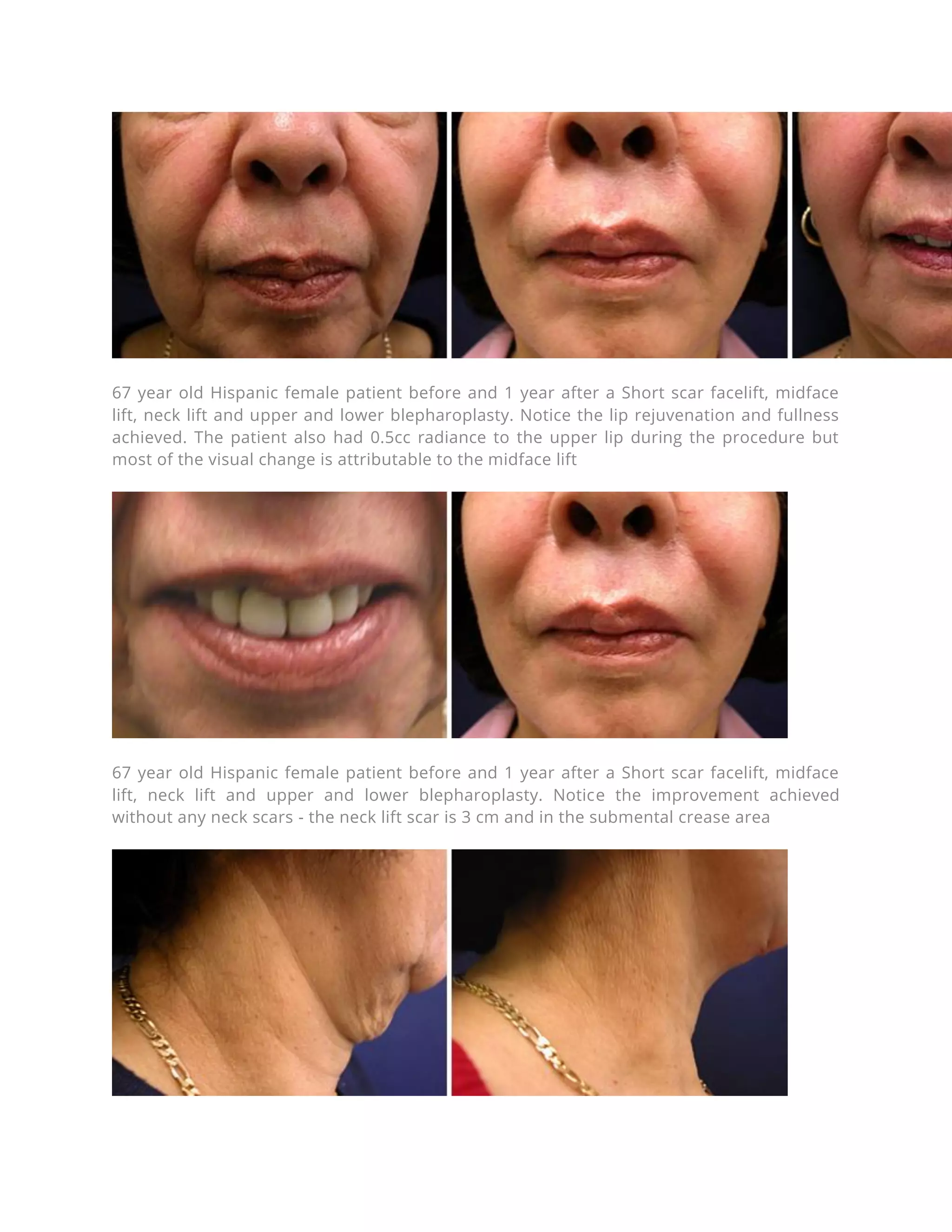 Minimal Incision Facelift Surgery and Lower Face Lift Incisions | PDF