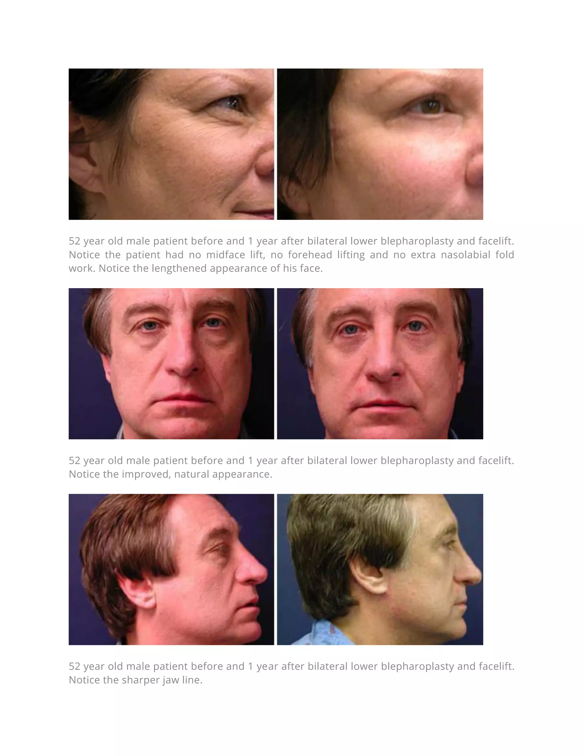 Minimal Incision Facelift Surgery and Lower Face Lift Incisions | PDF