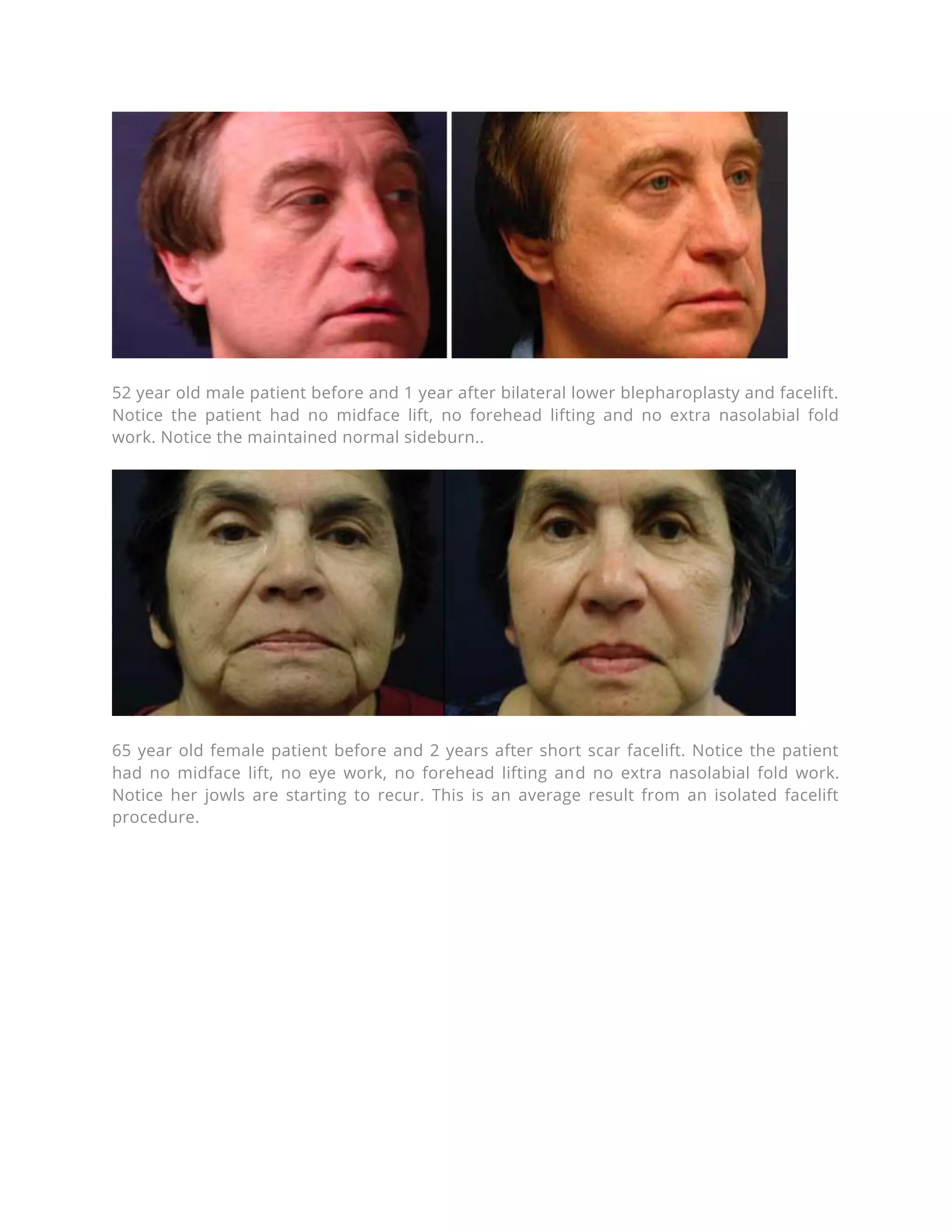 Minimal Incision Facelift Surgery and Lower Face Lift Incisions | PDF