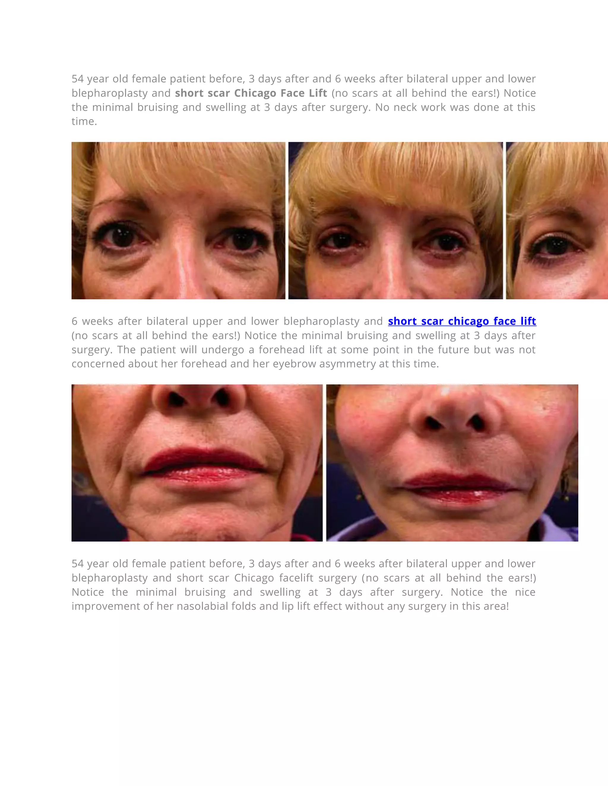 Minimal Incision Facelift Surgery and Lower Face Lift Incisions | PDF