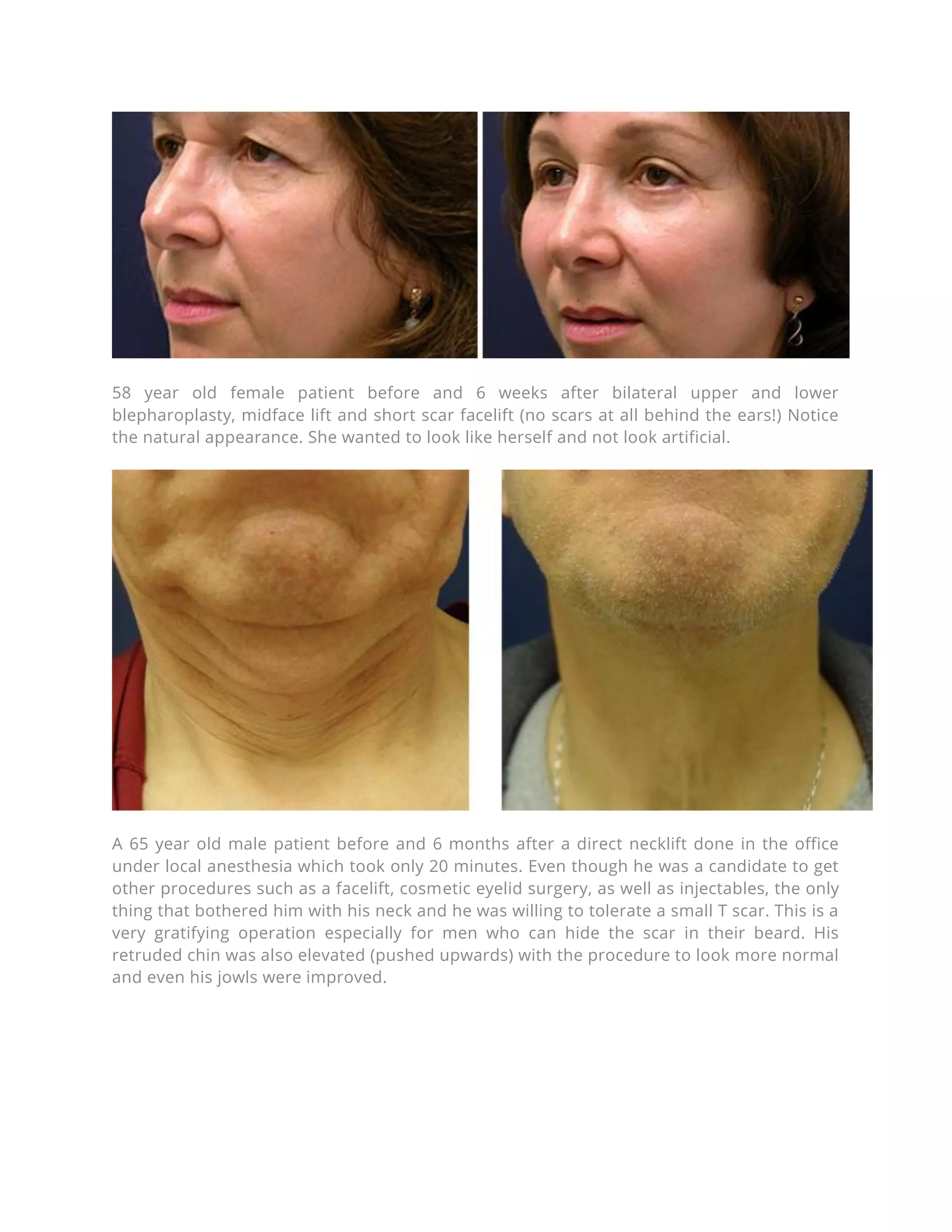Minimal Incision Facelift Surgery and Lower Face Lift Incisions | PDF