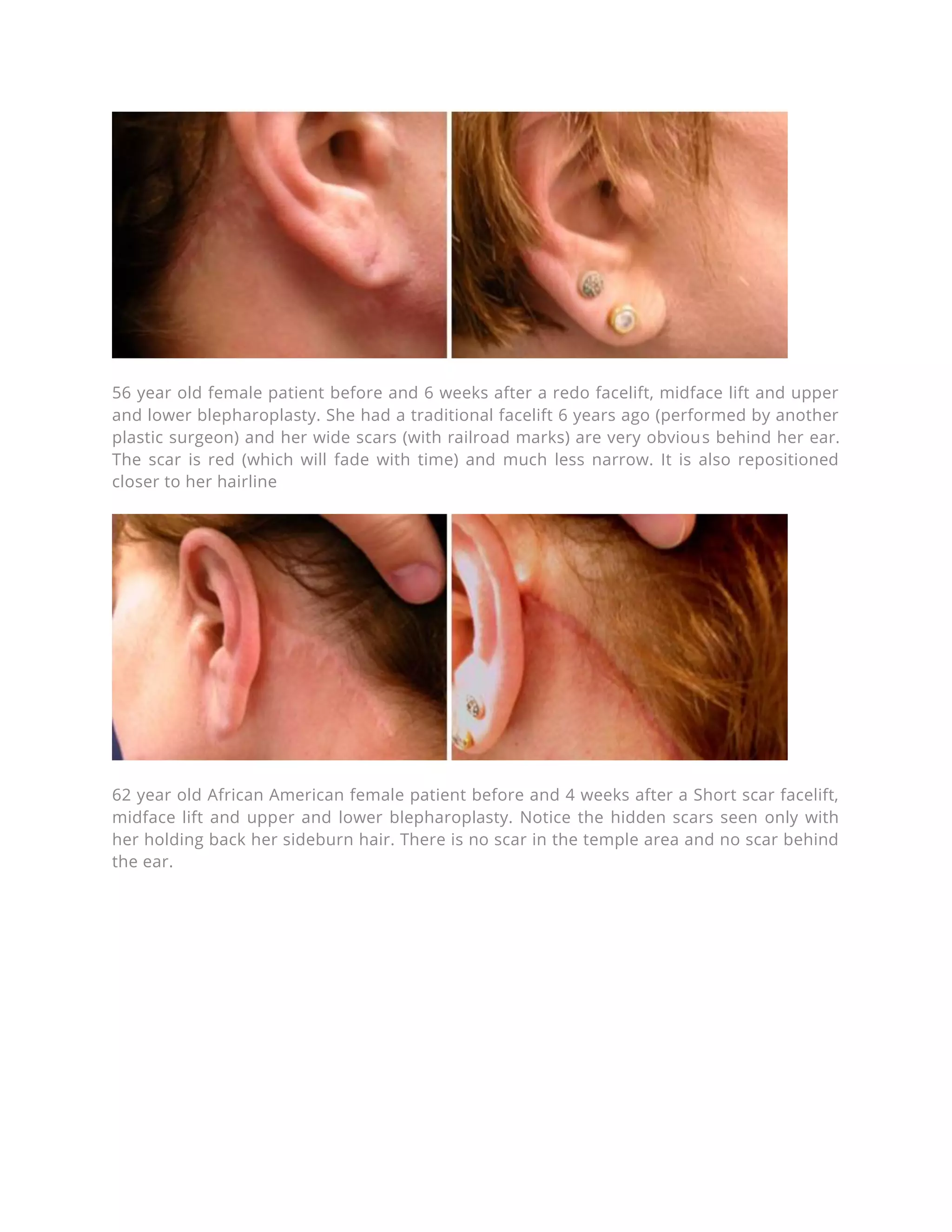 Minimal Incision Facelift Surgery and Lower Face Lift Incisions | PDF