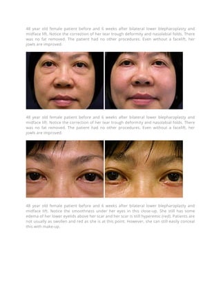 Minimal Incision Facelift Surgery and Lower Face Lift Incisions | PDF