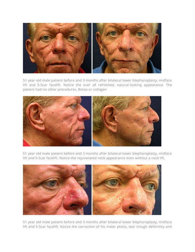 Minimal Incision Facelift Surgery and Lower Face Lift Incisions | PDF