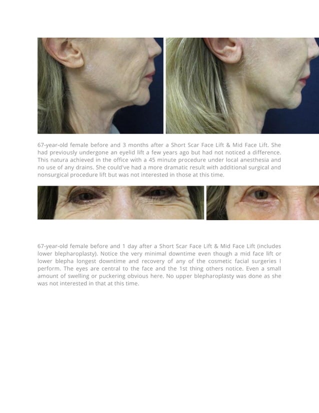 Minimal Incision Facelift Surgery and Lower Face Lift Incisions | PDF