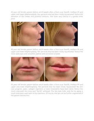 Minimal Incision Facelift Surgery and Lower Face Lift Incisions | PDF