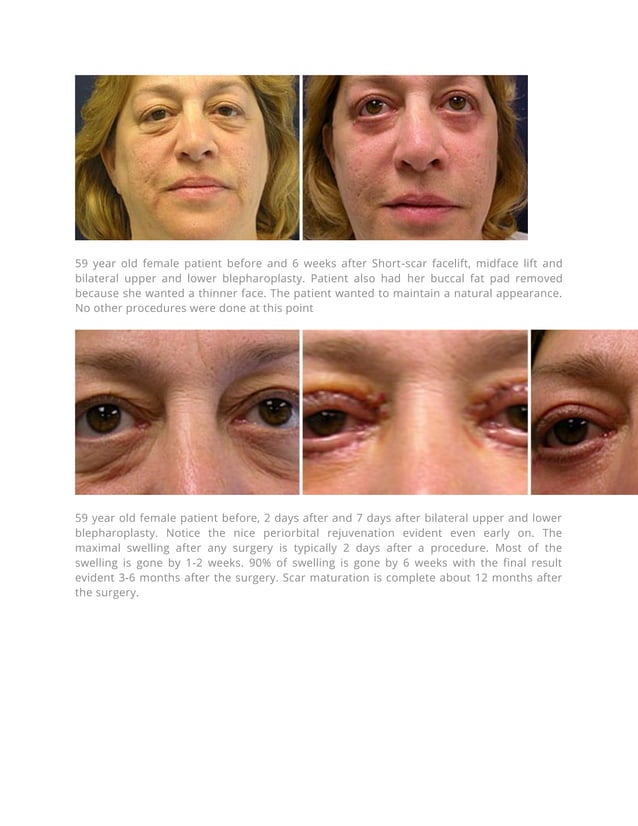 Minimal Incision Facelift Surgery and Lower Face Lift Incisions | PDF