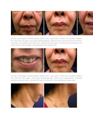 Minimal Incision Facelift Surgery and Lower Face Lift Incisions | PDF