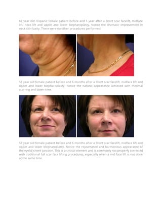 Minimal Incision Facelift Surgery and Lower Face Lift Incisions | PDF