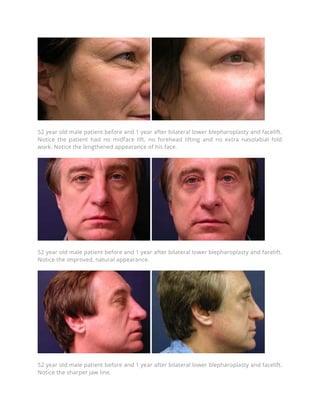 Minimal Incision Facelift Surgery and Lower Face Lift Incisions | PDF
