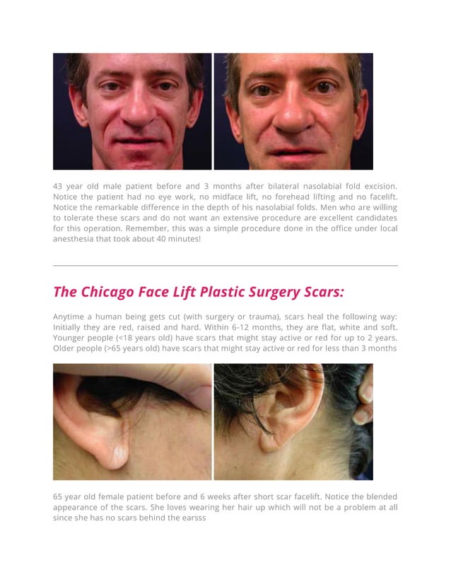 Minimal Incision Facelift Surgery and Lower Face Lift Incisions | PDF