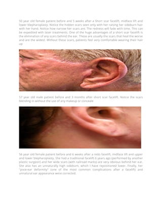 Minimal Incision Facelift Surgery and Lower Face Lift Incisions | PDF