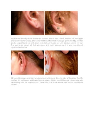 Minimal Incision Facelift Surgery and Lower Face Lift Incisions | PDF