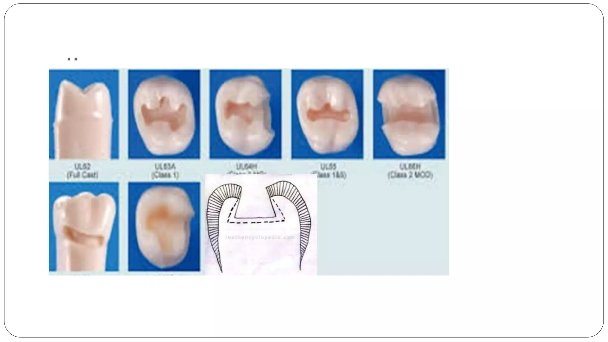 Minimal intervention dentistry vs g.v black | PPTX