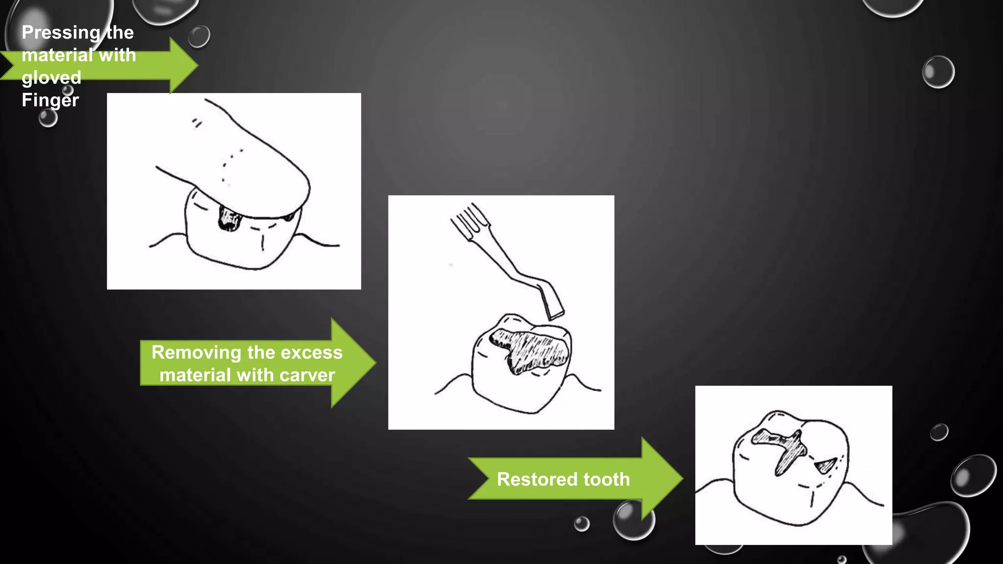 Minimal invasive dentistry | PPTX