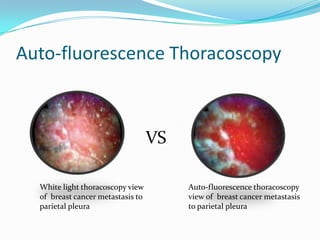 Minimal invasive cardiothoracic surgery2 | PPTX