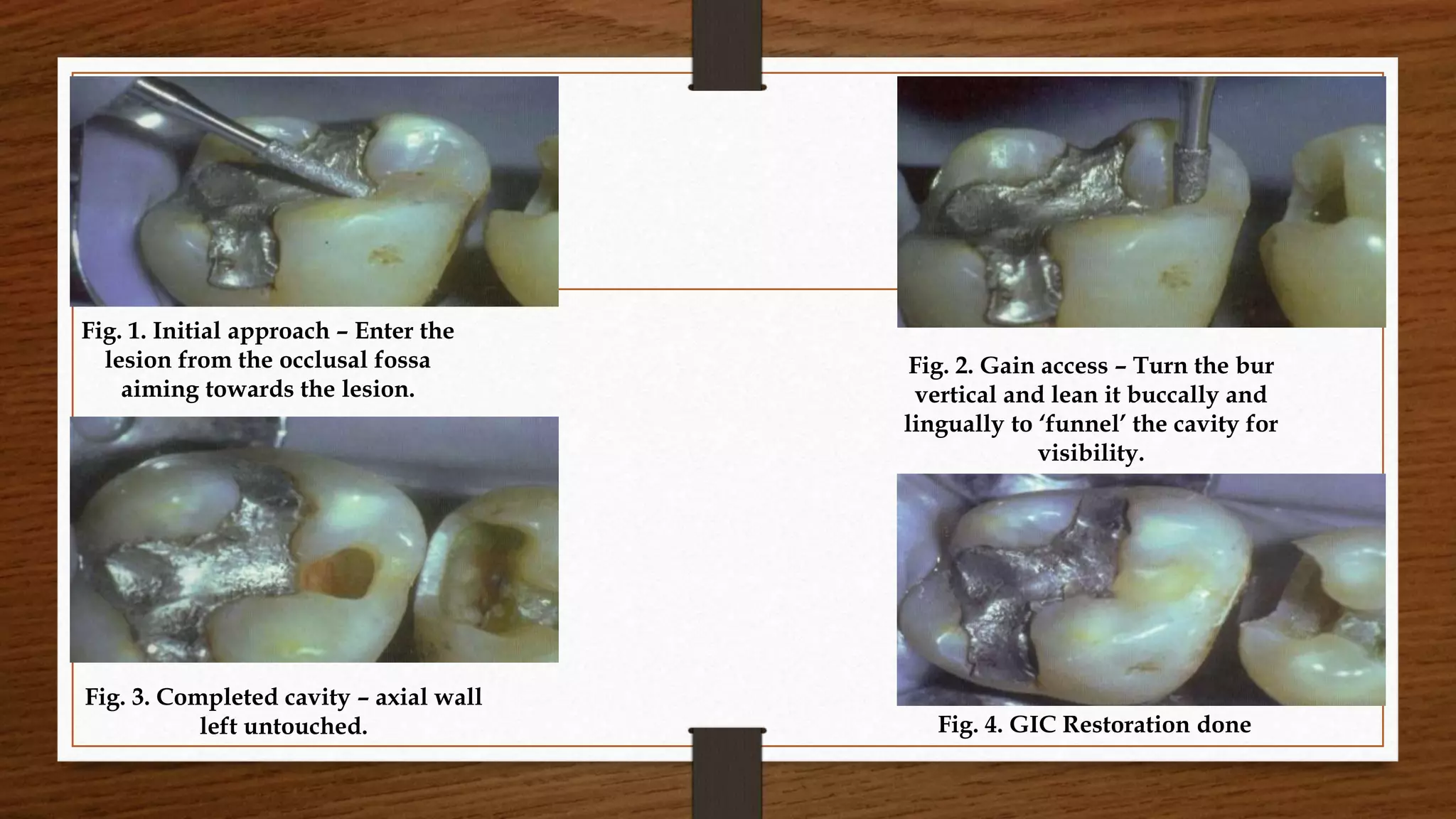 Minimal invasive dentistry in caris management.pptx
