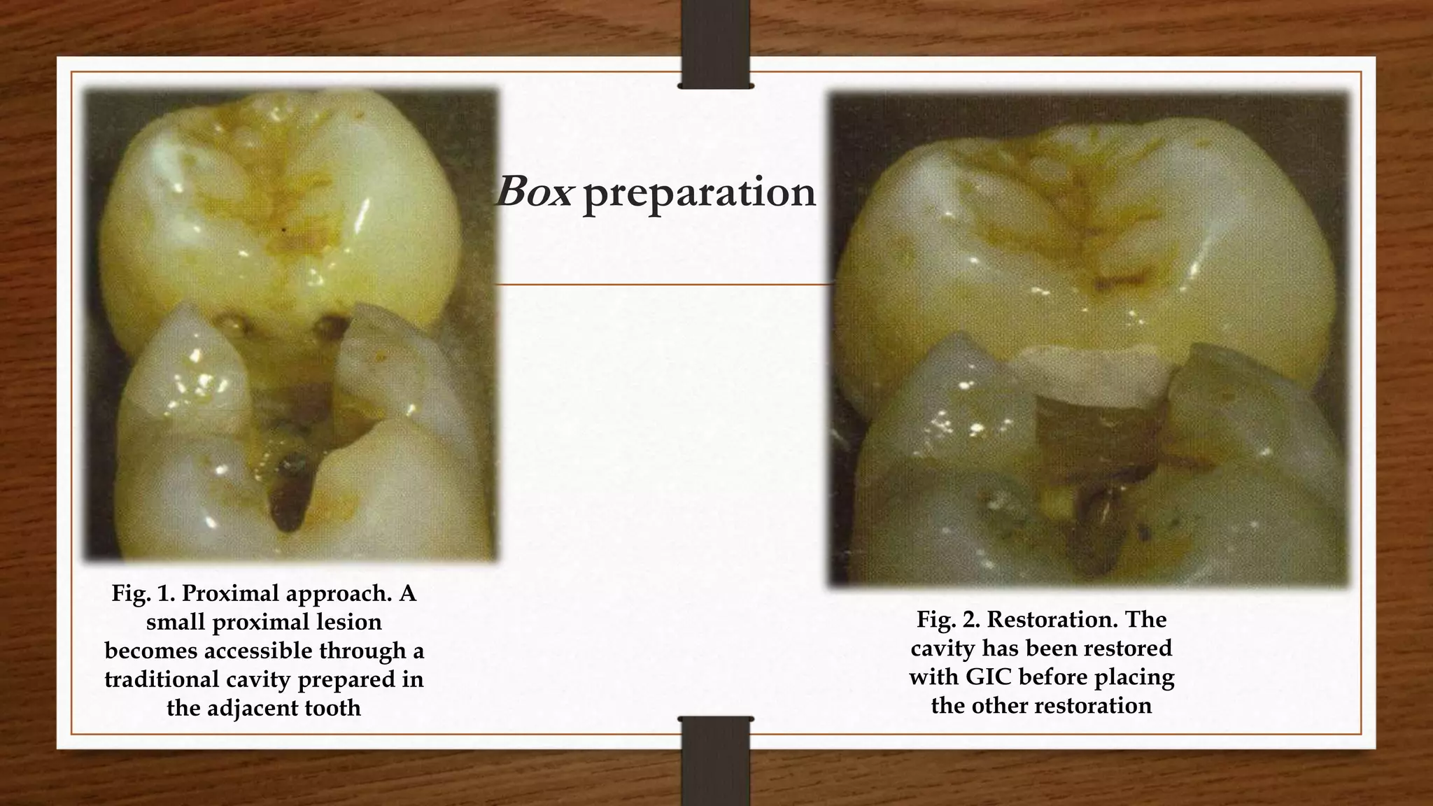 Minimal invasive dentistry in caris management.pptx