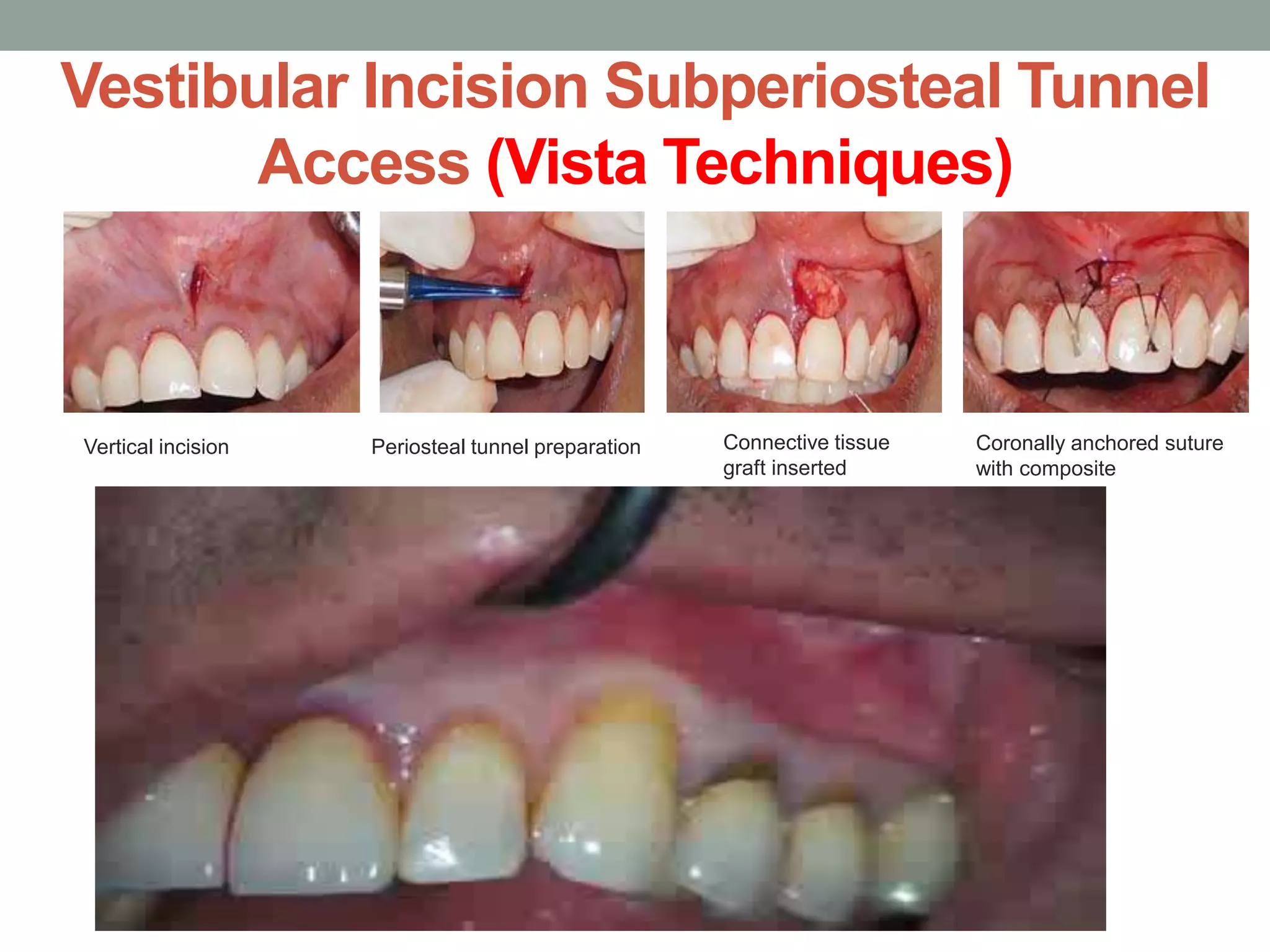 Minimal invasive techniques | PPTX