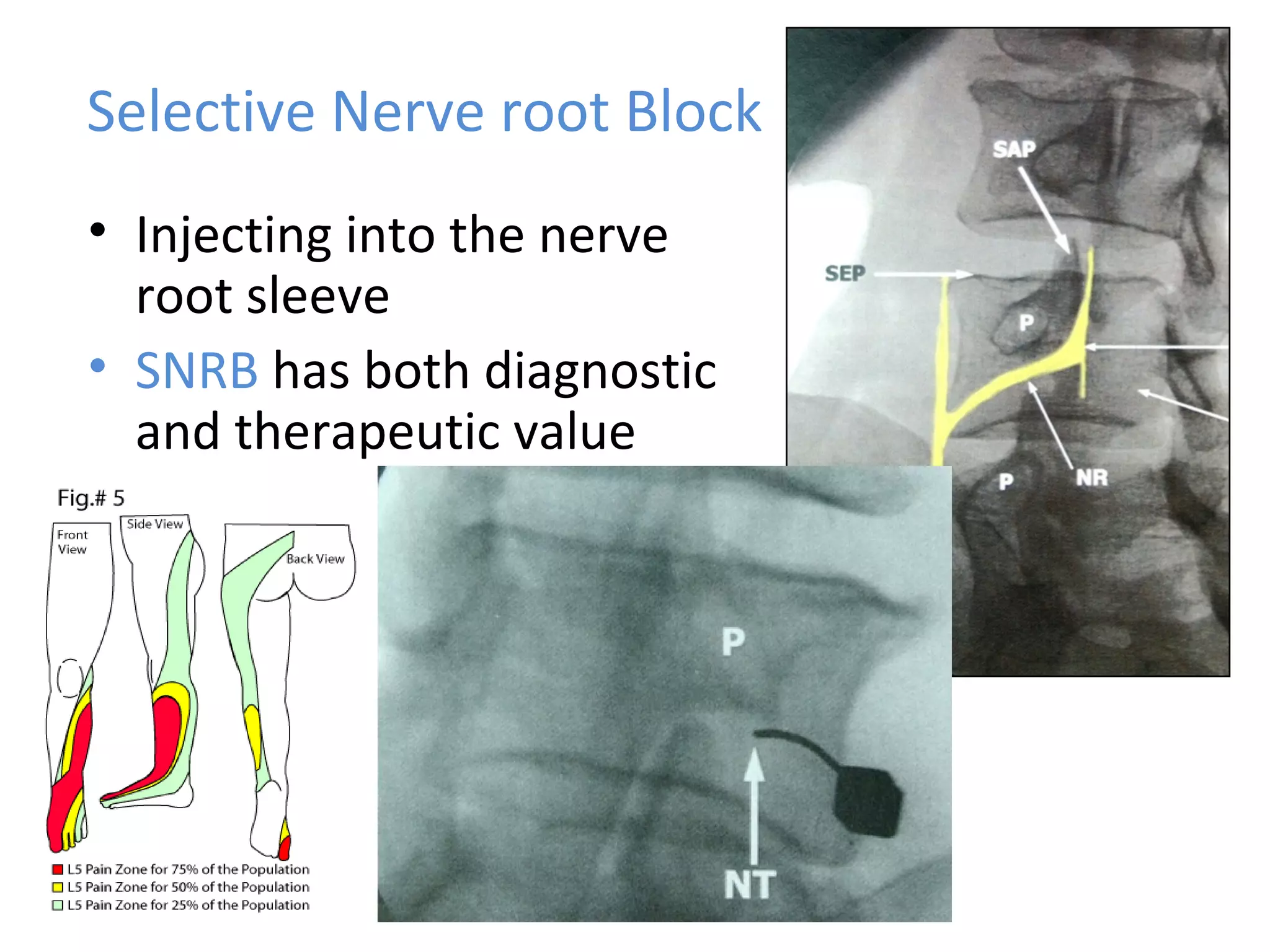 Minimal invasive techniques in lumbar degenerative diseases | PPT