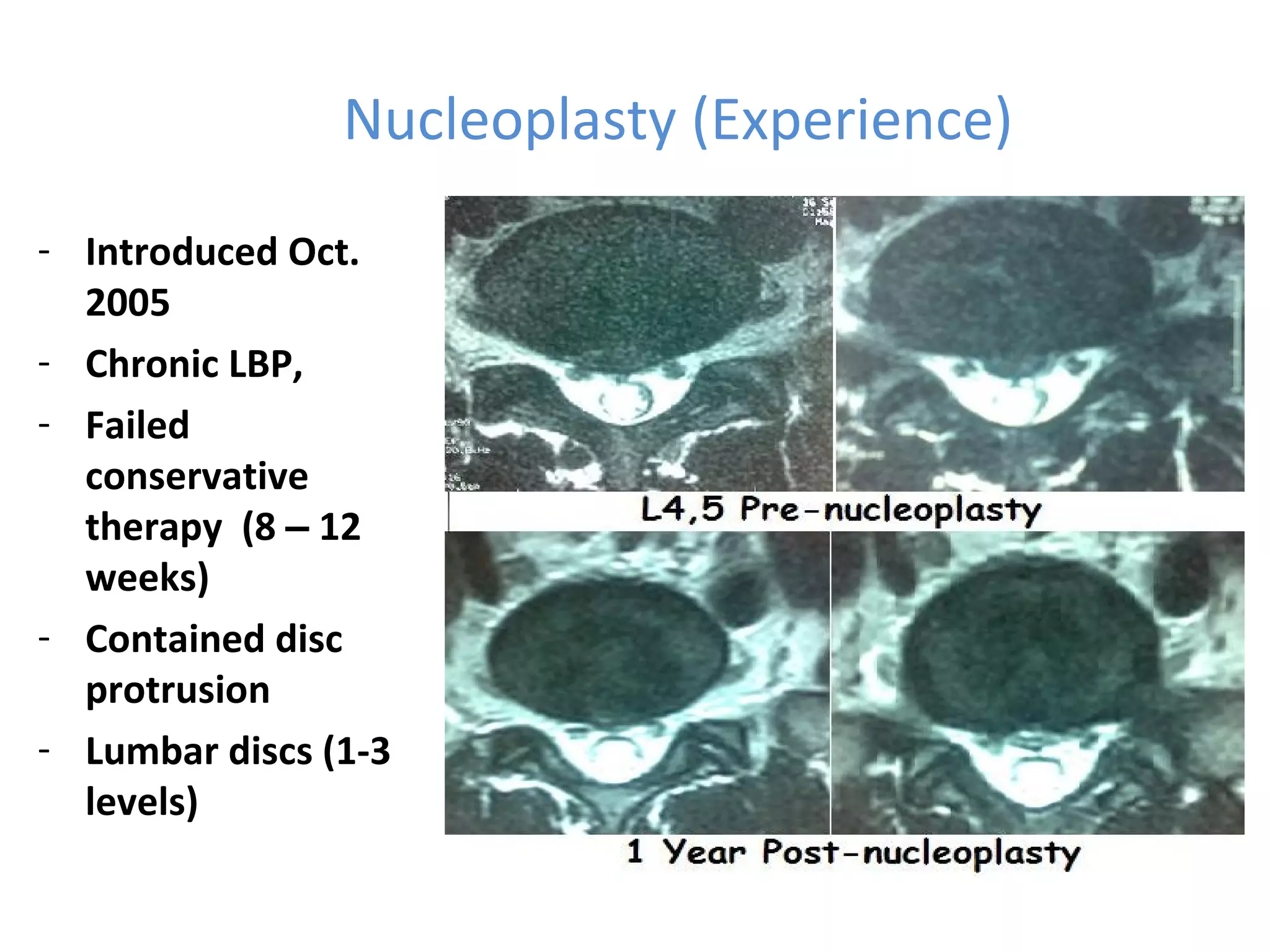Minimal invasive techniques in lumbar degenerative diseases | PPT