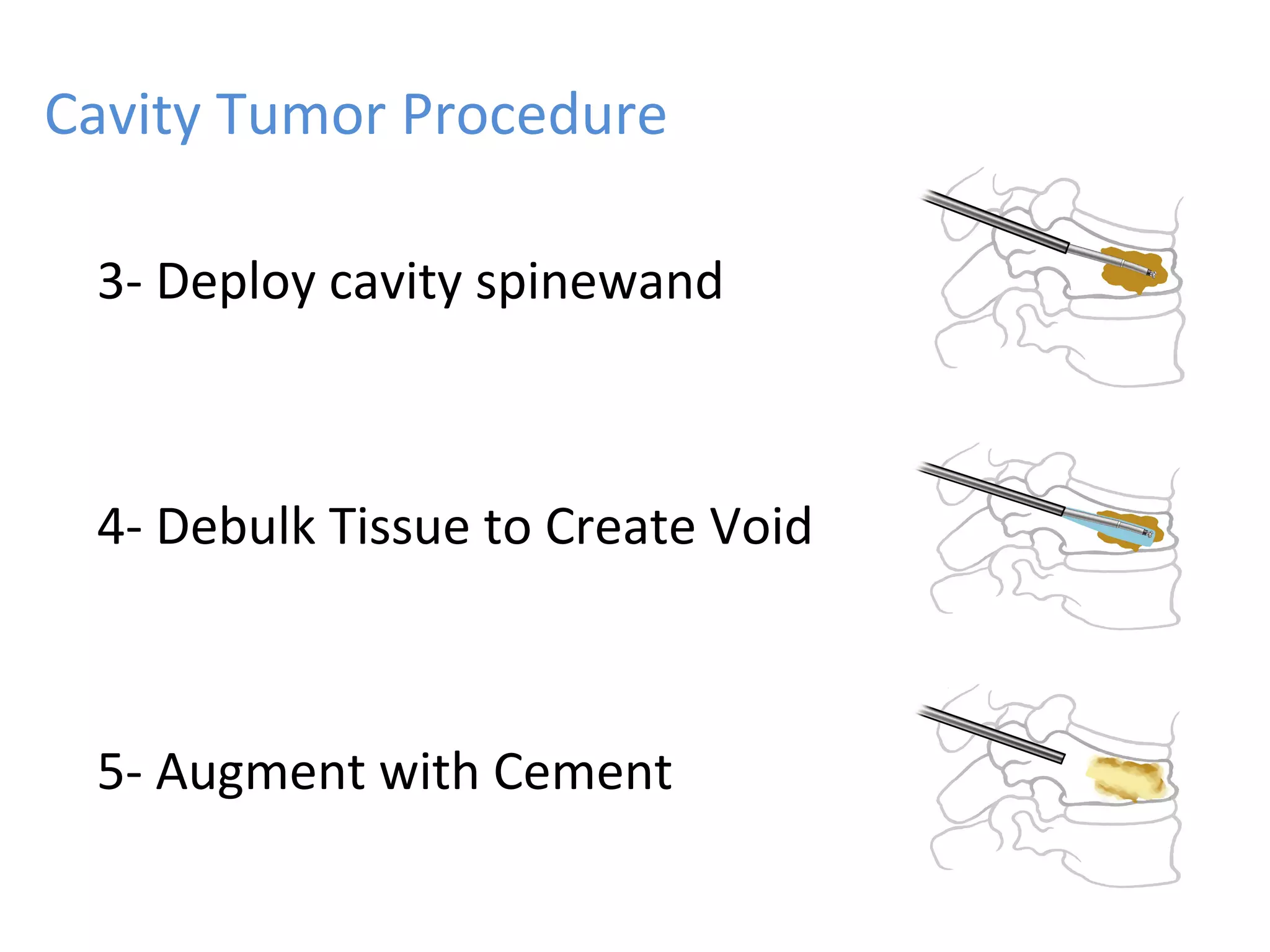 Minimal invasive techniques in lumbar degenerative diseases | PPT