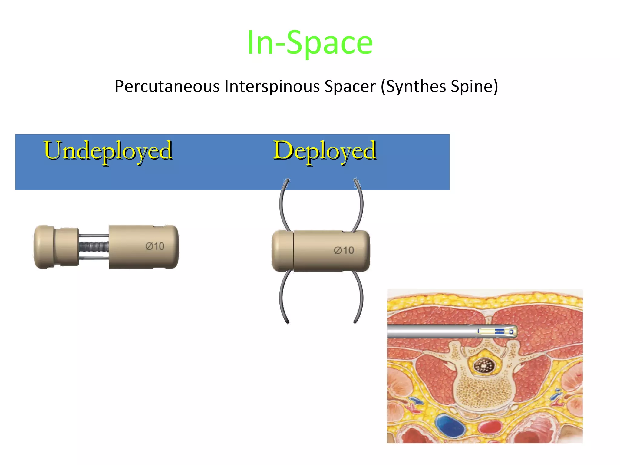 Minimal invasive techniques in lumbar degenerative diseases | PPT