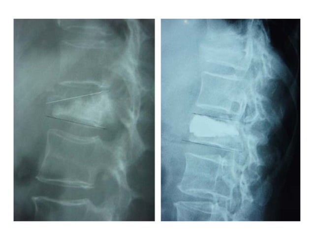 Minimal invasive techniques in lumbar degenerative diseases | PPT ...