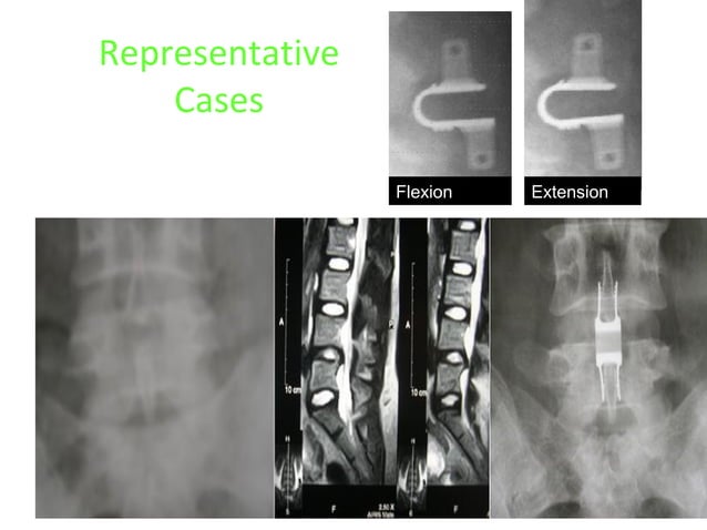 Minimal invasive techniques in lumbar degenerative diseases | PPT ...