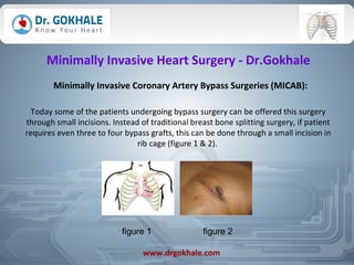 Minimally Invasive Heart Surgery - Dr Gokhale | PPT