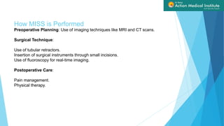 Minimally Invasive Spine Surgery | Sri Balaji Action Medical Institute ...