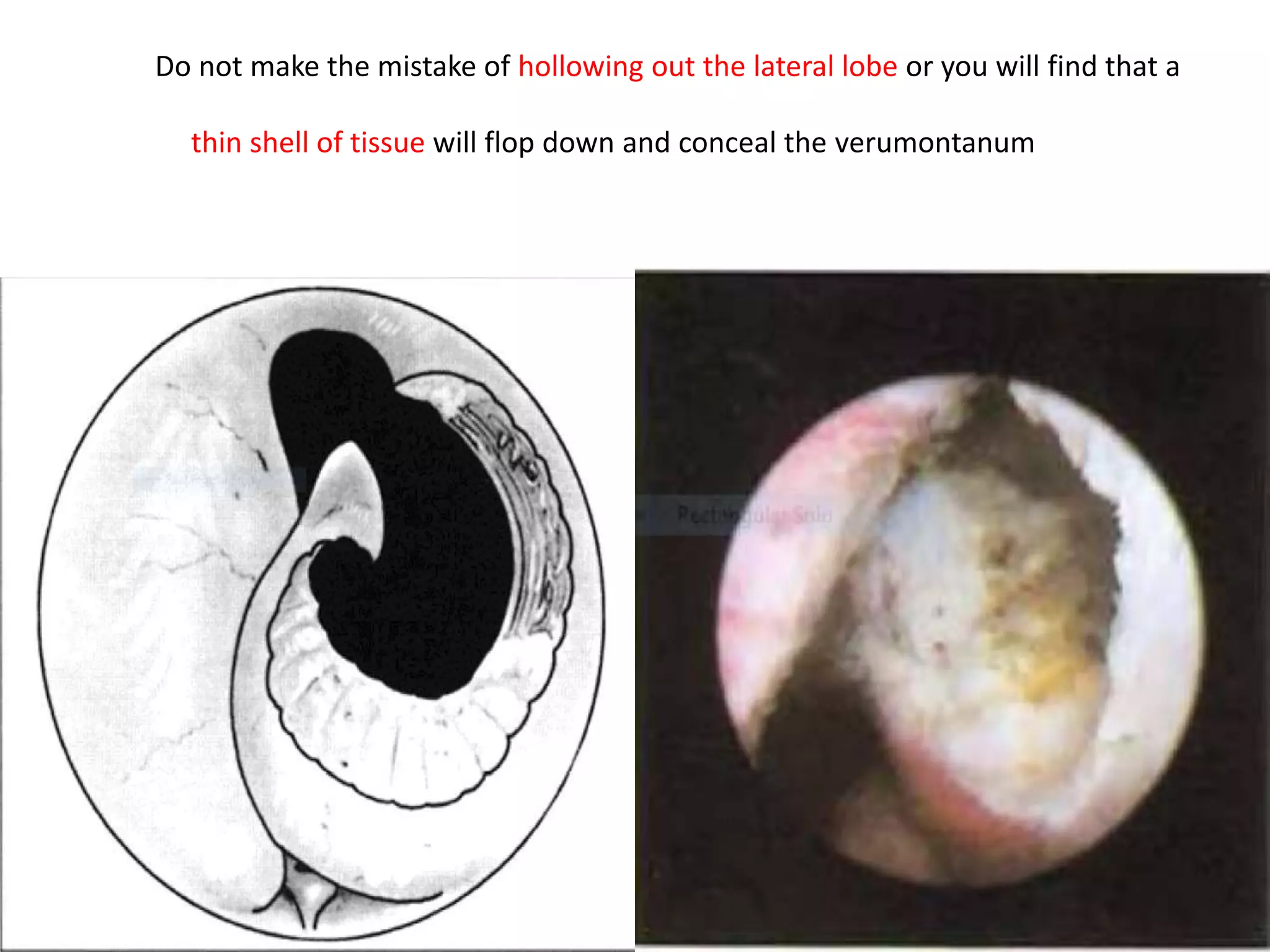 Minimally invasive and endoscopic management of benign prostatic | PPTX