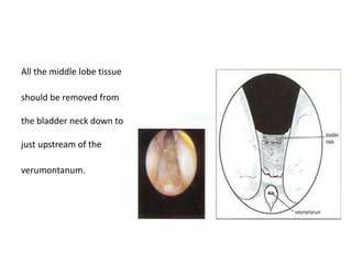 Minimally invasive and endoscopic management of benign prostatic | PPTX