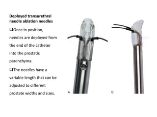 Minimally invasive and endoscopic management of benign prostatic | PPTX