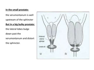 Minimally invasive and endoscopic management of benign prostatic | PPT