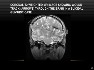 MINIMALLY_INVASIVE_AUTOPSY (post mortem).ppt