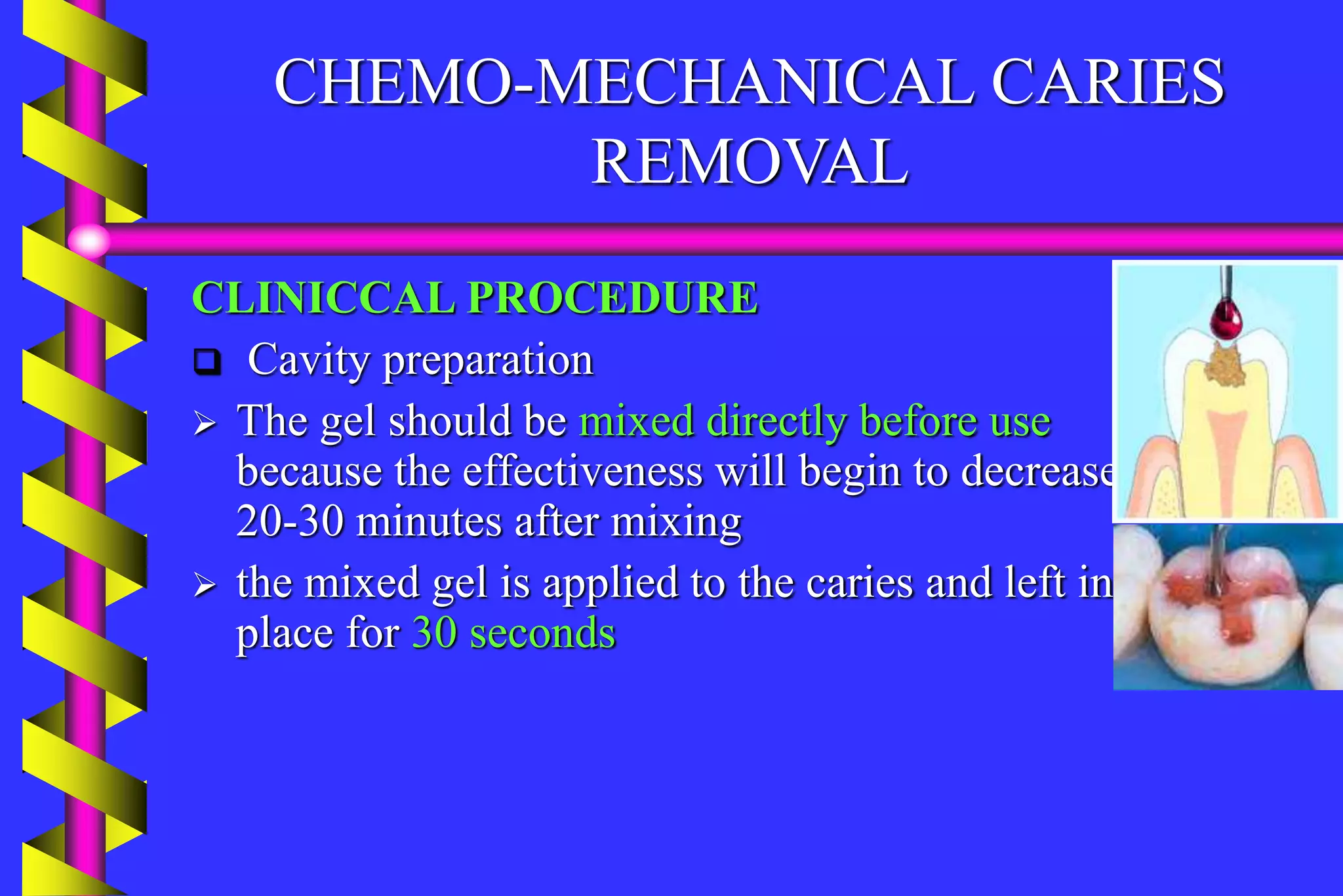Minimally invasive caries therapy part 2 | PPT