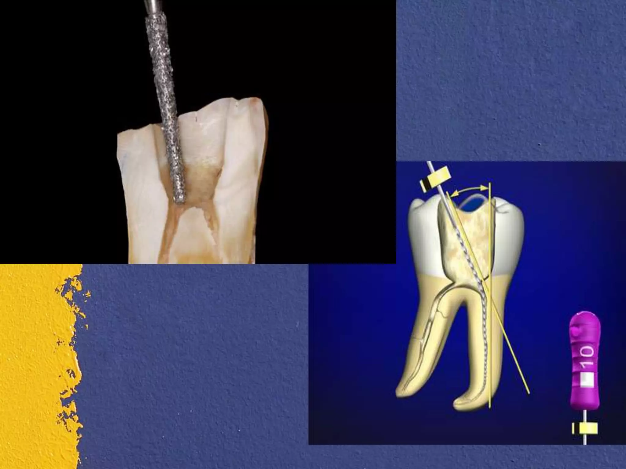 Minimally invasive endodontics by Dr. JAGADEESH KODITYALA | PPTX