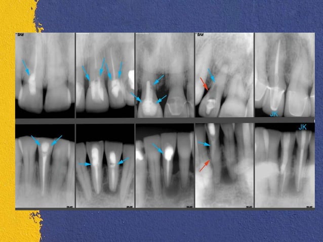 Minimally invasive endodontics by Dr. JAGADEESH KODITYALA | PPTX ...