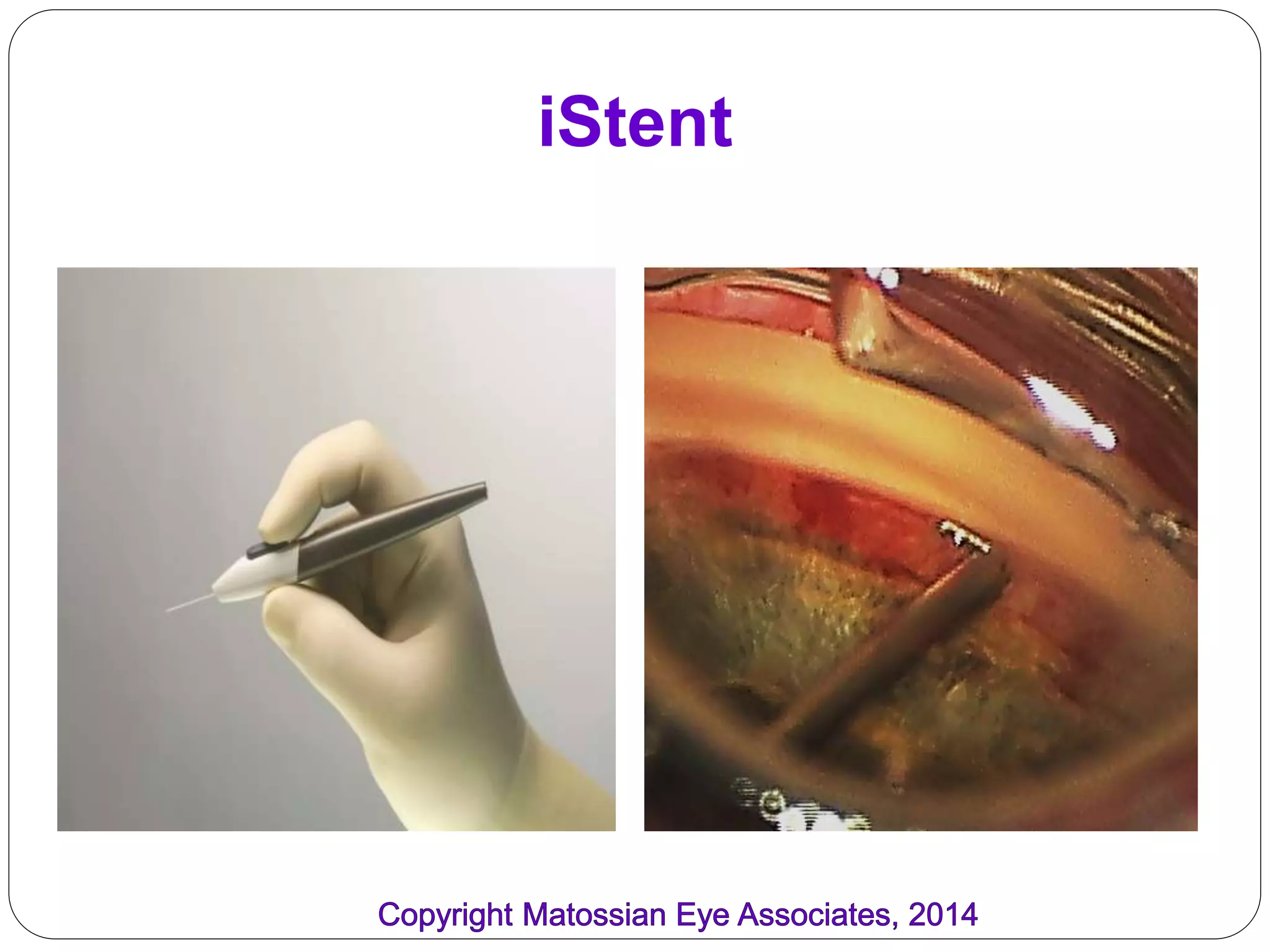 Minimally Invasive Glaucoma Surgery Pptx