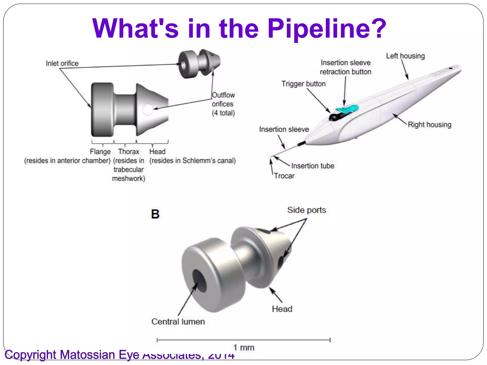 Minimally Invasive Glaucoma Surgery Pptx