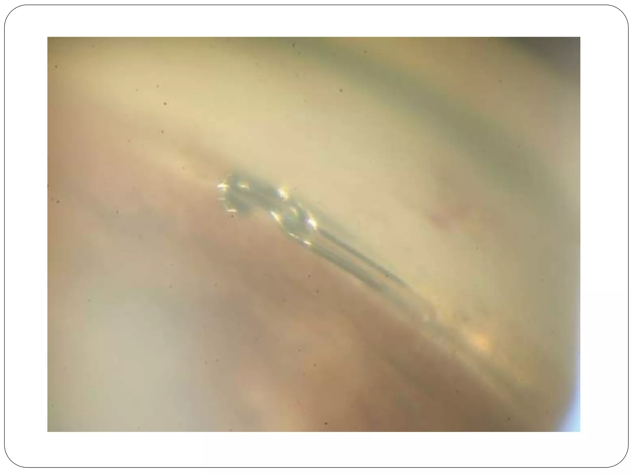 Minimally Invasive Glaucoma Surgery Pptx