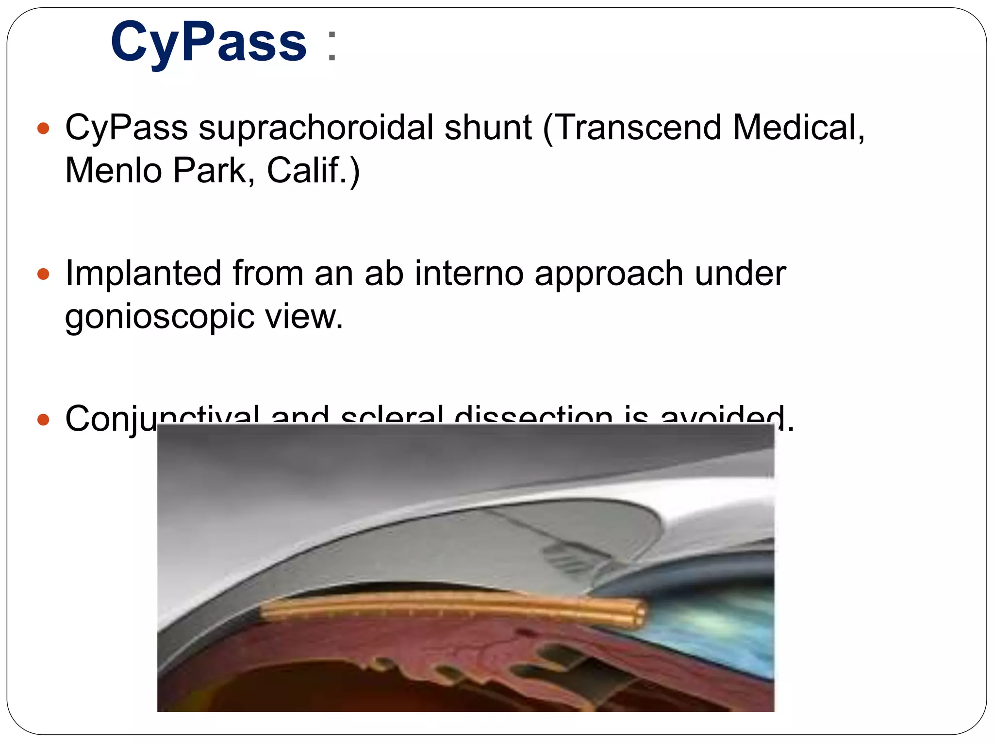 Minimally invasive glaucoma surgery | PPTX