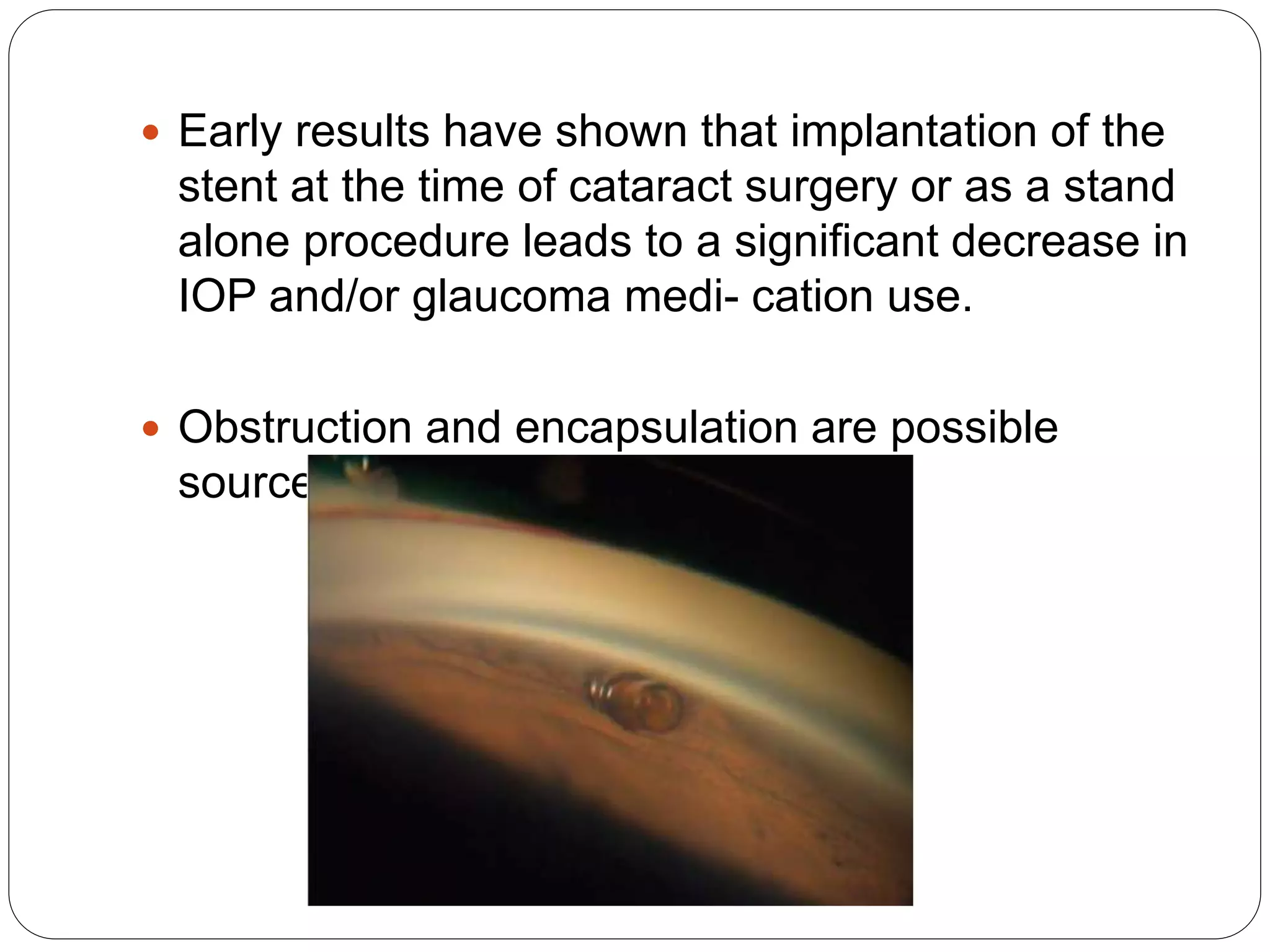 Minimally invasive glaucoma surgery | PPTX