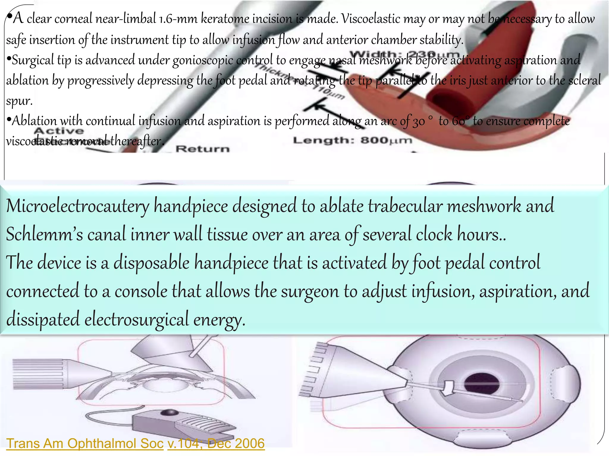 Minimally invasive glaucoma surgery | PPTX