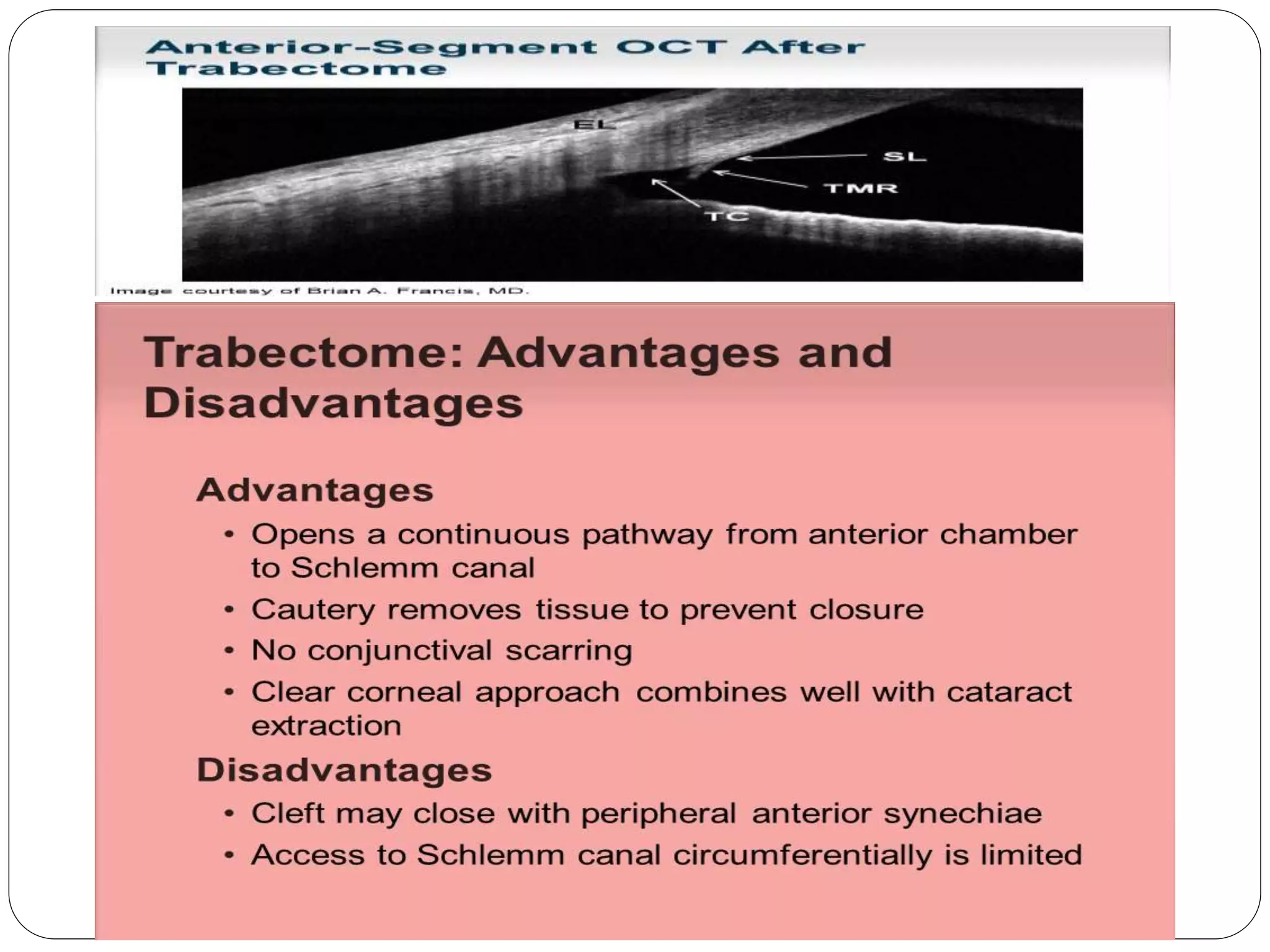 Minimally Invasive Glaucoma Surgery Pptx