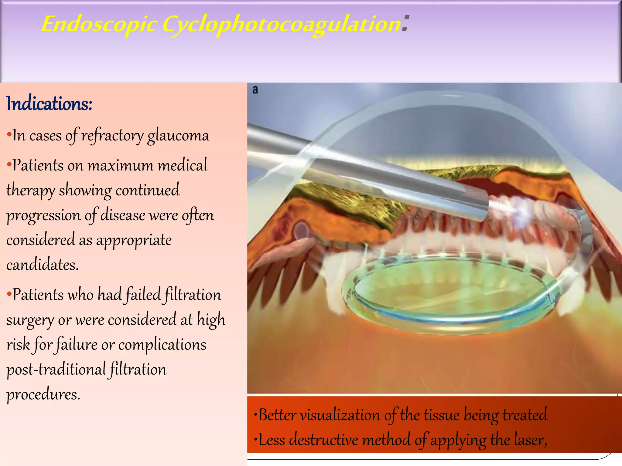 Minimally invasive glaucoma surgery | PPTX